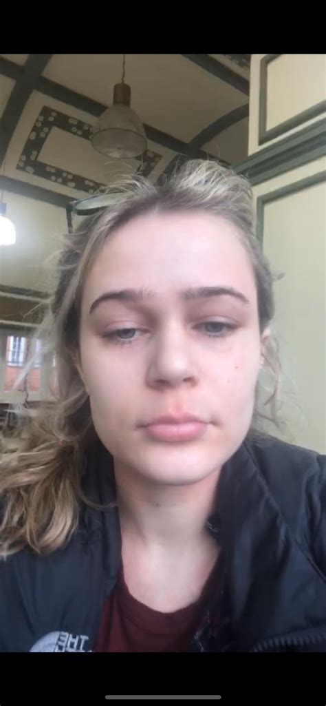 Acromegaly R Acromegaly