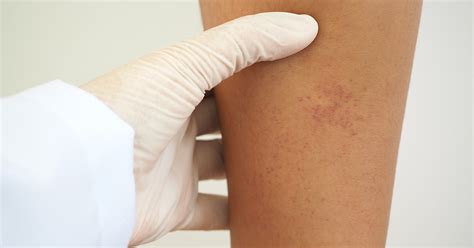 Itp Causes Symptoms And Treatment Options