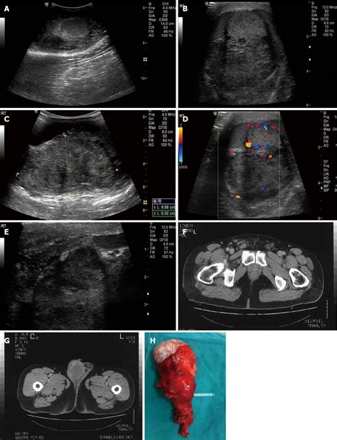 Figure 1 From Imaging Features Of A Huge Spermatic Cord Leiomyosarcoma