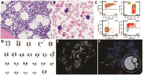 Relapsed Npm1 Mutated Acute Myeloid Leukemia With Pdgfra Rearrangement
