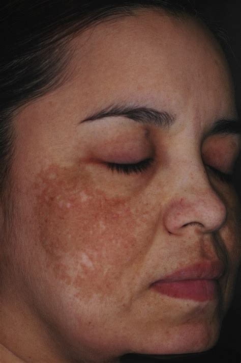 Melasma Treatments Best Results On Long Island Messina Esthetic Medicine