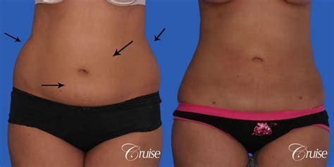 Liposuction Before And After Gallery Patient 17