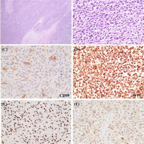 Morphological And Immunohistochemical Features Of The Sarcoma A Hande Download Scientific