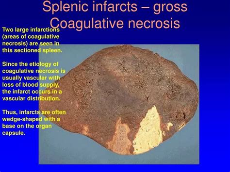 Ppt Splenic Infarcts Gross Coagulative Necrosis Powerpoint Presentation Id1321943