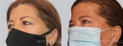 Eyelid Surgery White Hill Clinic For Women