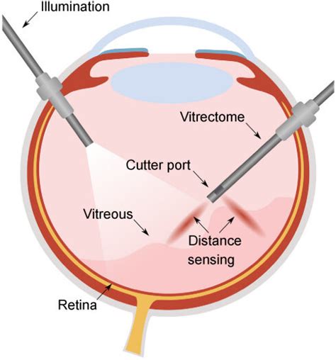 Illustration Of The Vitrectomy Procedure The Developed Sensor Is