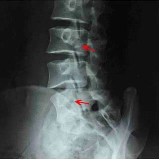 Oblique View Of Lumbar Spine