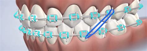 Bite Correction Services In Tx Full Smile Orthodontics