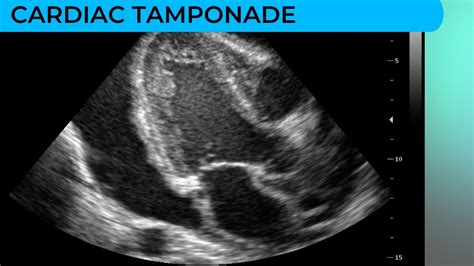 Pericardial Tamponade Troubled Heart On Ultrasound Scan Youtube