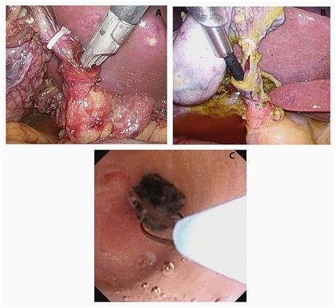 Surgical Procedure Of Transcystic Intraoperative Cholangioscopy A The Download Scientific