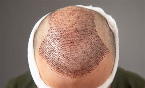 Advanced Hair Restoration Cost How Much Should You Pay