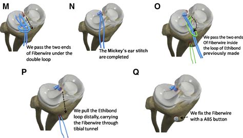 Posterior Meniscal Root Repair Using A Meniscal Suture Device