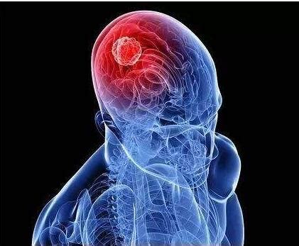 脑肿瘤分型 脑肿瘤分几种类型 肿瘤 医生在线