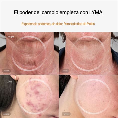 Lyma Wellness Boutique Experience Láser Lyma