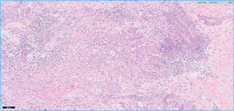 A Case Of Peristomal Pyoderma Gangrenosum With Histological Features Of A Case Of Peristomal Pyoderma Gangrenosum With Histological Features Of