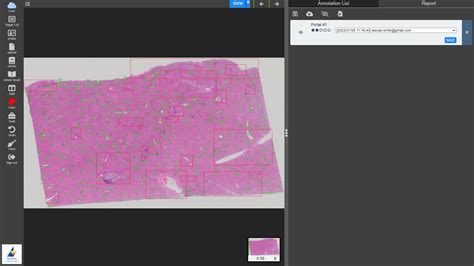 肝臟腫瘤偵測與肝炎分析之數位病理ai｜國家新創獎