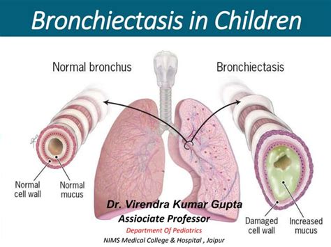 Bronchiectasis Pptx