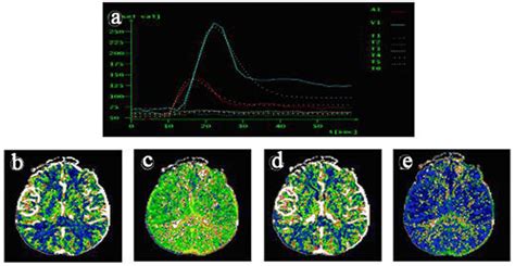 non cms subject 43 year old male brain ct perfusion images including