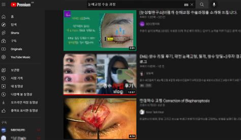 내 돈 내산 남자 눈매교정 앞트임 성형수술 후기 네이버 블로그