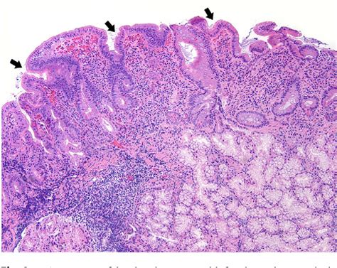 Figure 2 From Gastric Foveolar Metaplasia And Gastric Heterotopia In The Duodenum No Evidence