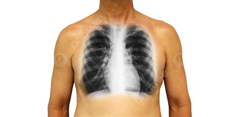 Isolated Background Showcasing Normal Lung Xray Of The Hospital