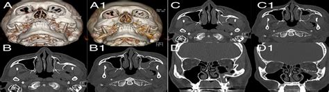 Is Gillies Temporal Incision Necessary To Successfully Reduc Journal Of Craniofacial Surgery
