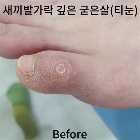 깊은 굳은살티눈 변형 굳은살