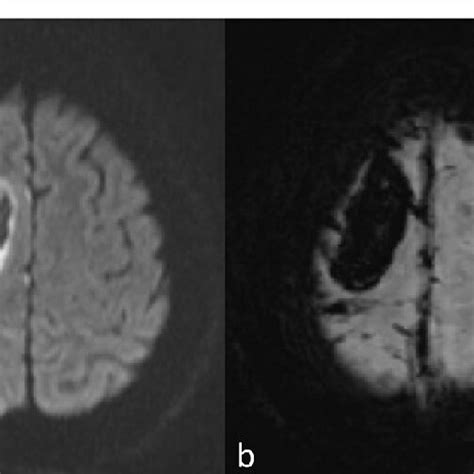 A Diffusion Weighted And B Susceptibility Weighted Mri Sequences
