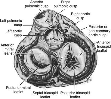Acquired Aortic Valve Disease Thoracic Key