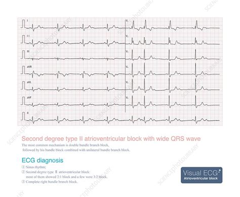 Second Degree Type Ii Atrioventricular Block Illustration Stock Image C053 0203 Science