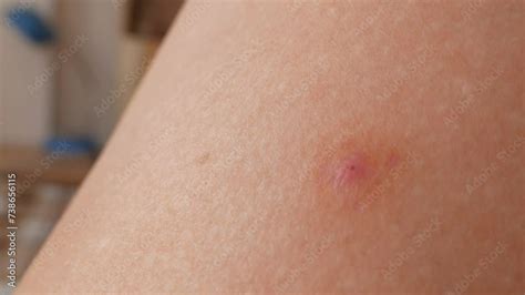 Mosquito Bites Ticks On Womans Legs Big Red Spots On Skin Lyme Disease Stock Video Adobe Stock