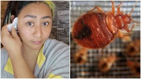 Joven Teme Por Su Vida Tras Ser ‘picada Por Una Chinche “la Roncha Se