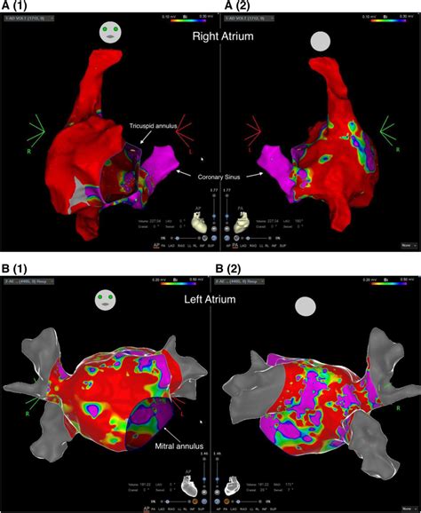 Voltage Map Of The Right A And The Left Atrium B Depicting Download Scientific Diagram