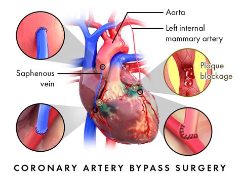 Expert Cabg Surgery In Hyderabad Top Cardiac Surgeons