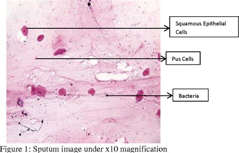 Detection And Summation Of Squamous Epithelial Cells In Sputum Slide