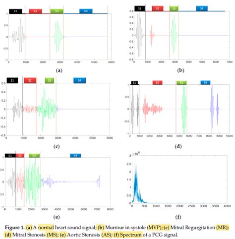 Brief Review — Classification Of Heart Sound Signal Using Multiple Features By Sik Ho Tsang