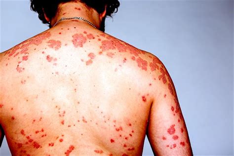 أعراض الإيدز على الجلد 10 علامات لا تتجاهلها الكونسلتو