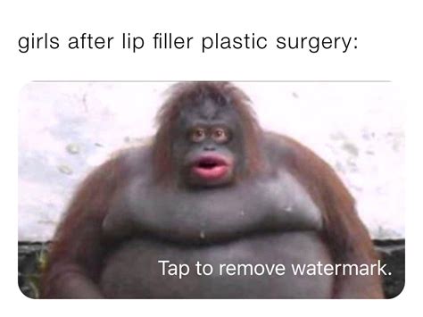 Lip Filler Memes At Lucille Gabriel Blog