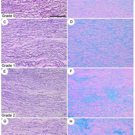 Adventitial Fibrosis Grade 2 This Index Case Refers To A 69 Year Old Download Scientific
