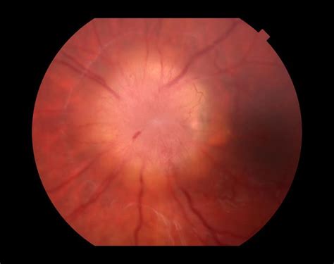 Pseudopapilledema And Papilledema Seeing Through The Swelling