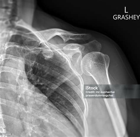 X Ray Shoulder Joint Anatomy At Darcy Poninski Blog