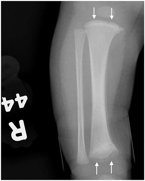 Distal Tibia And Fibula Radiographs Demonstrated Classic Metaphyseal Download Scientific