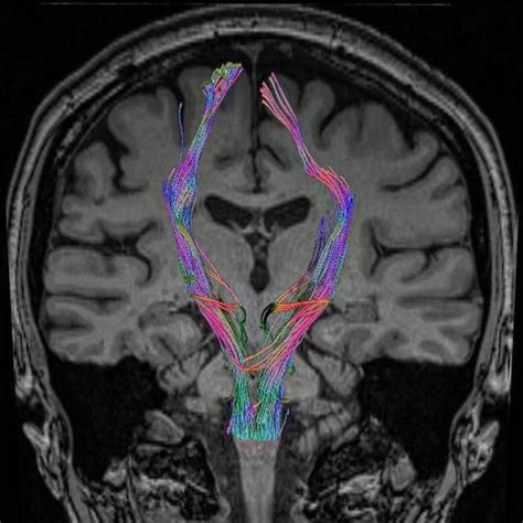 Vahid Shahmaei On Linkedin Mri Dti Corticospinal