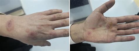 The Dorsum And Palmar Surface Of The Left Hand Showed Polymorphous