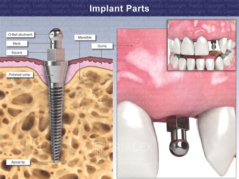 Dental Implants Trialquest Inc