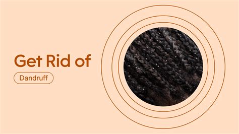 How To Get Rid Of Dandruff 4 Personal Remedies That Worked Goodrx