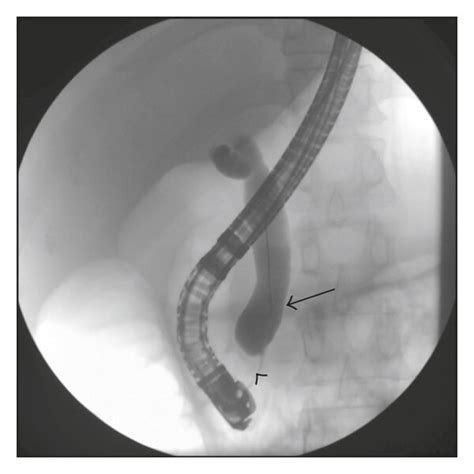 A Ercp With Cholangiogram Showing Dilated Common Bile Duct Pointed