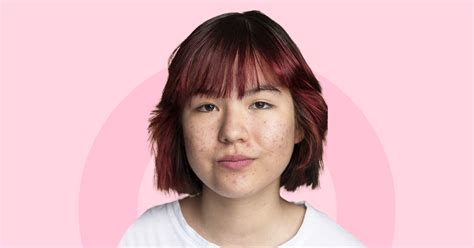 Cystic Acne Causes And Treatment Ova Sg