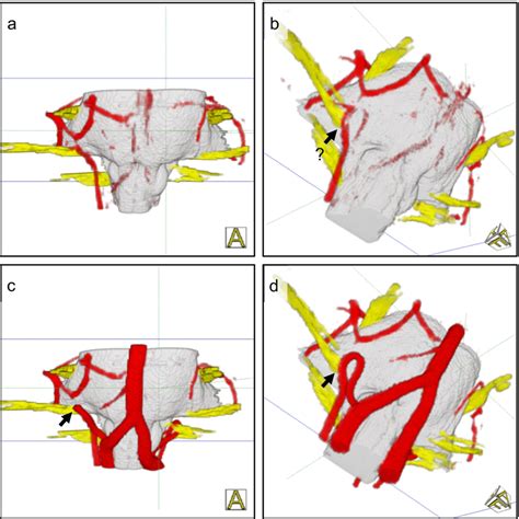 3d Visualization Of A Right Sided Hemifacial Spasm Before Fusion Download Scientific Diagram