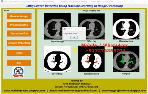 Lung Cancer Detection Using Machine Learning Technique Matlab Project Source Code ENGINEERING